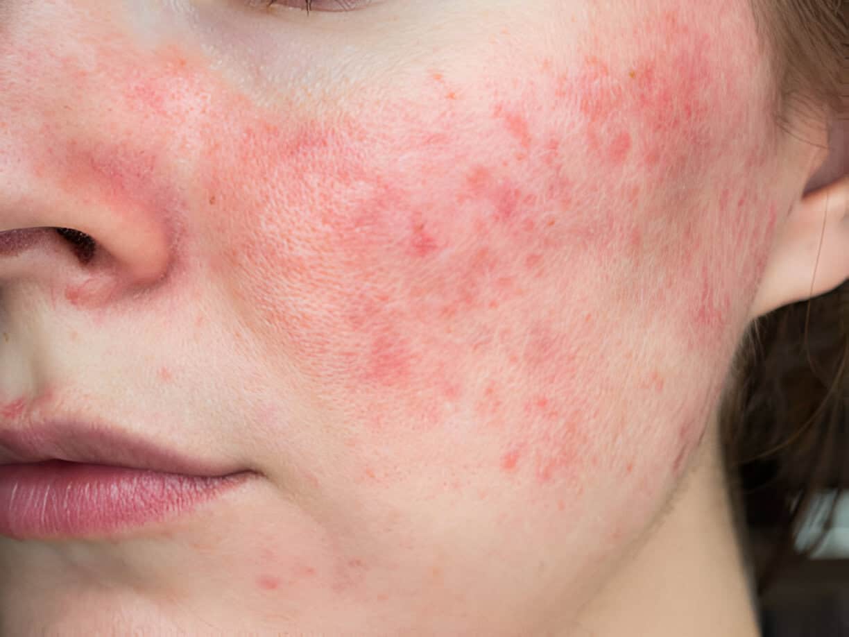 Best Korean Skincare for Rosacea: Top Picks & Tips